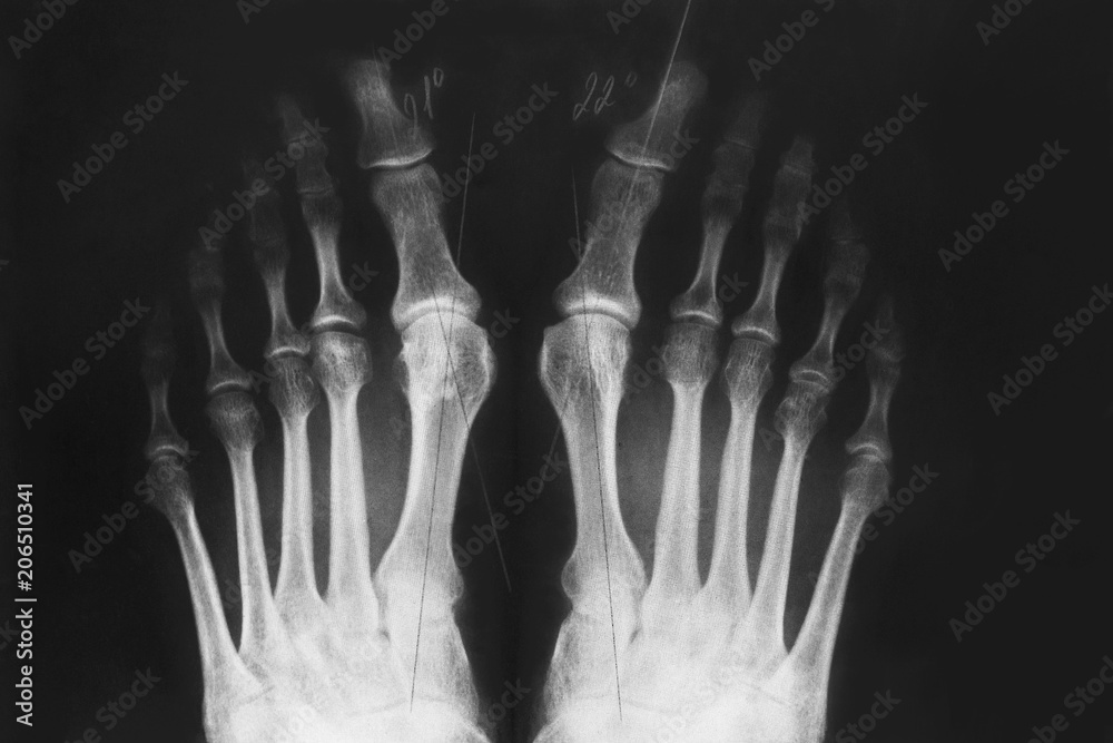 X-ray of the foot, valgus deformity of the toe Stock Photo | Adobe Stock