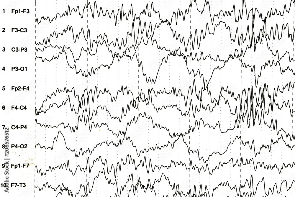 Brain Wave Patterns On Electroencephalogram Eeg Of The Pediatric