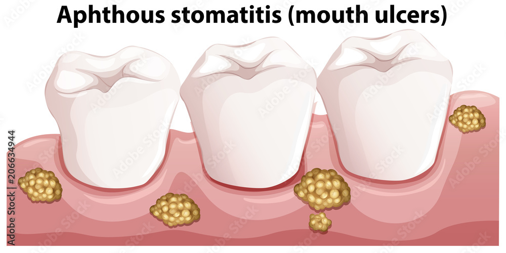 Human Anatomy of Aphthous Stomatitis Stock Vector | Adobe Stock