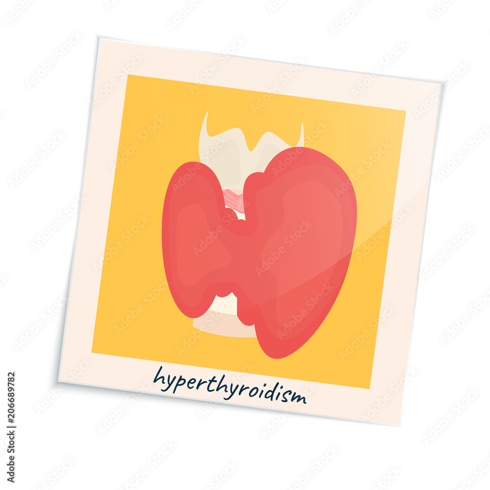 Thyroid gland disorder poster. Hyperthyroidism goiter symbol in a photo ...