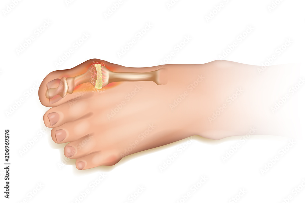 Gout. Human foot illustration Stock Photo | Adobe Stock