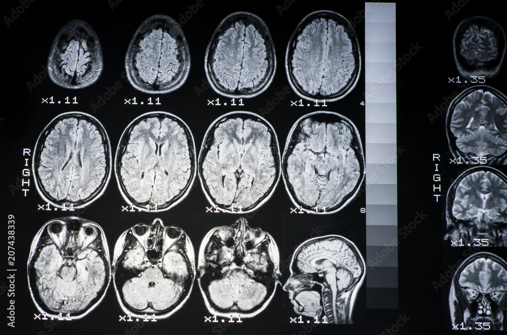 The result of MRI of the brain of a healthy person with a gray ...