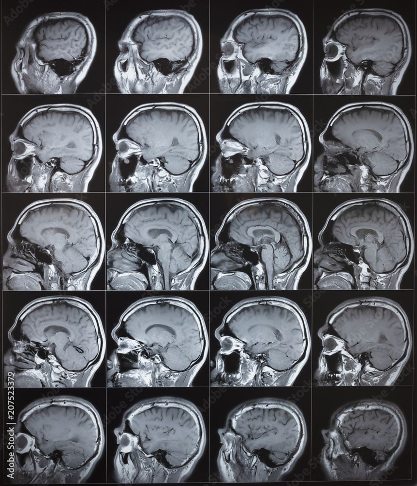 Mri Scan Brain Normal