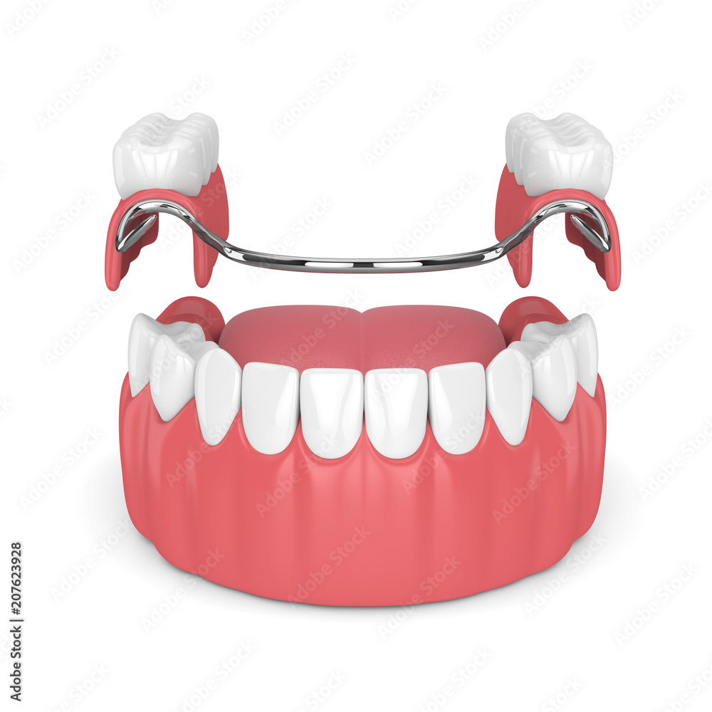 Poster 3d render of removable partial denture – Wall Art | UkPosters