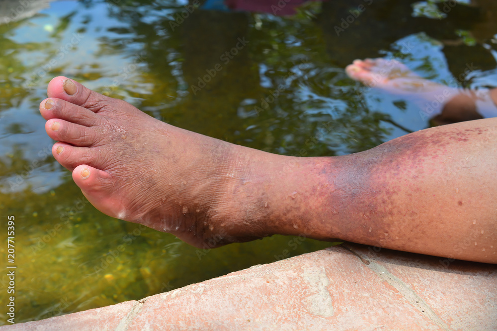 Natural hot spring relieves blood circulation, de-stressing, chronic ...