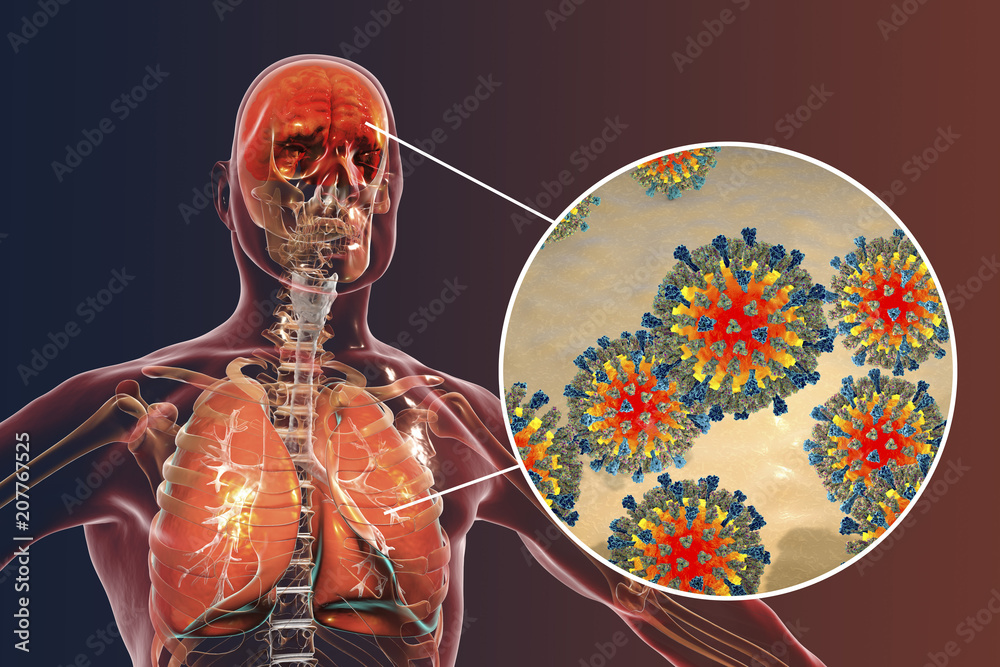 Measles induced complications, conceptual image. 3D illustration ...