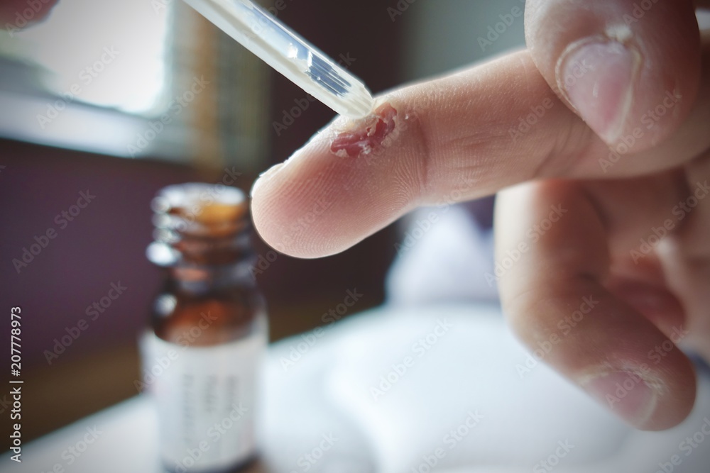 Filiform Warts: What They Look Like, Treatment, And Causes, 55% OFF