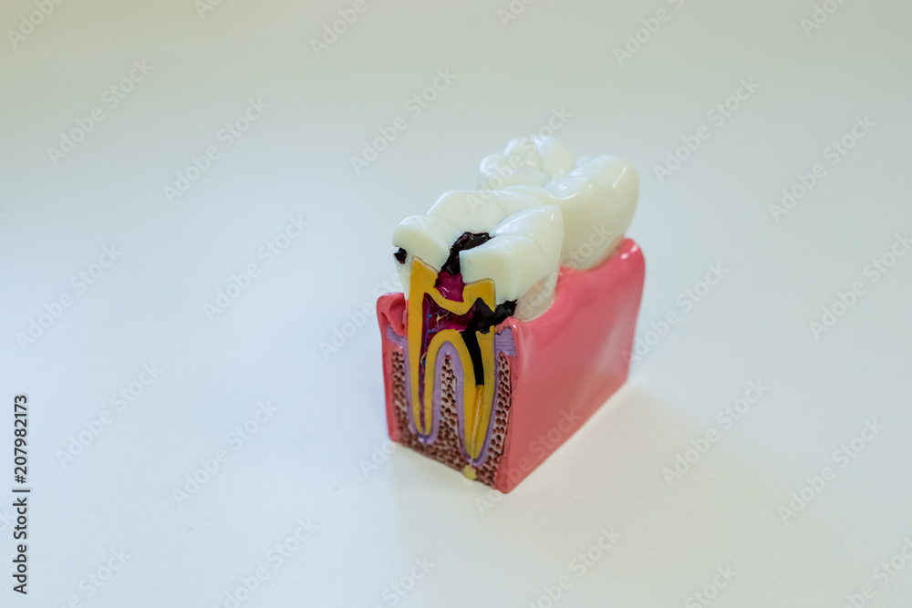 Tooth model for education in laboratory isolated. caries, tooth decay ...