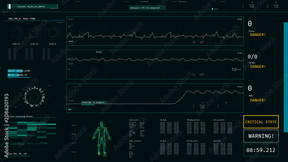 Patient's revival, ICU monitor with vital signs rising after cardiac ...