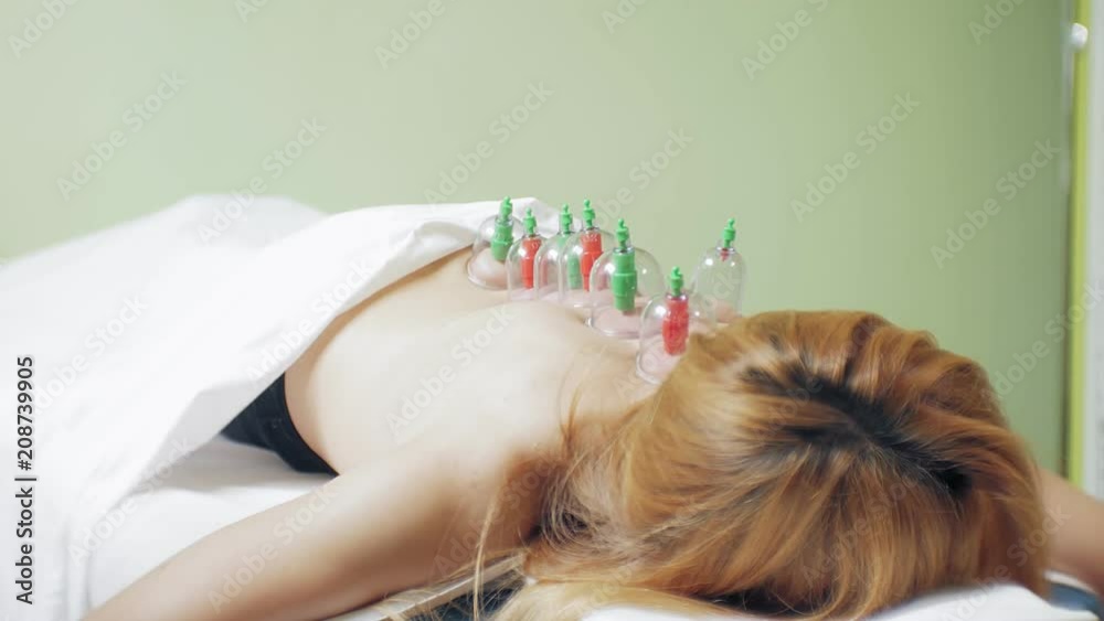 Traditional Chinese Medicine Cupping process. Hijamah Cups on back of female patient woman in ...