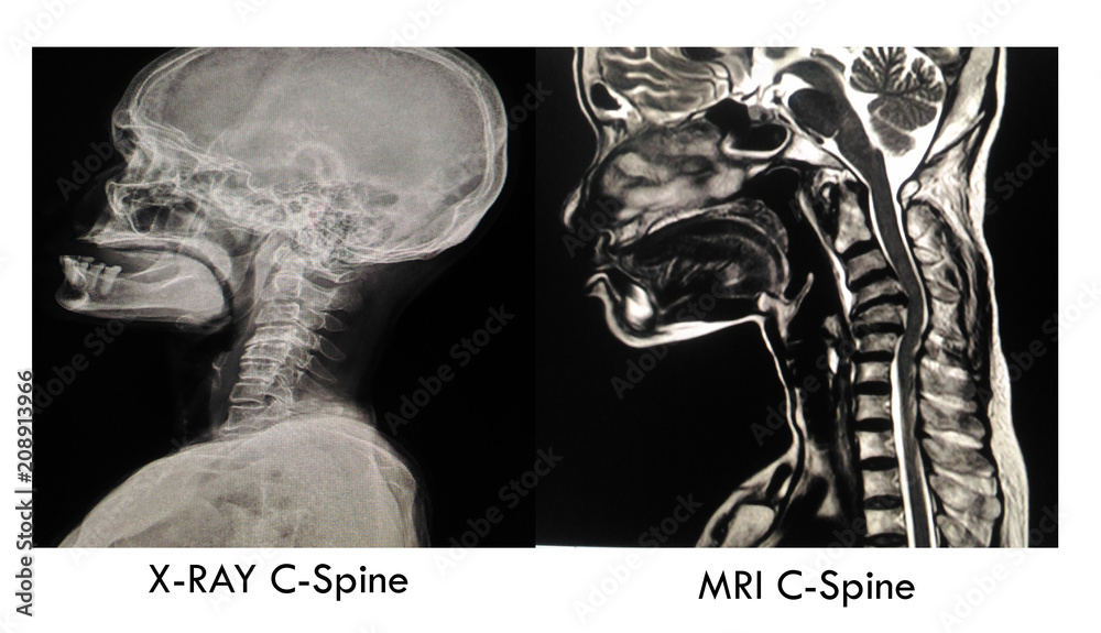 Cevical spine image Normal X-ray and MRI : showing Severe narrowing ...