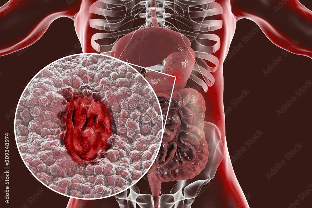 Gastric ulcer. Mucosa of stomach with ulcer and anatomy of human ...