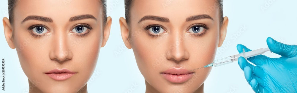 Female face, present before and after lip filler injections. Lip ...