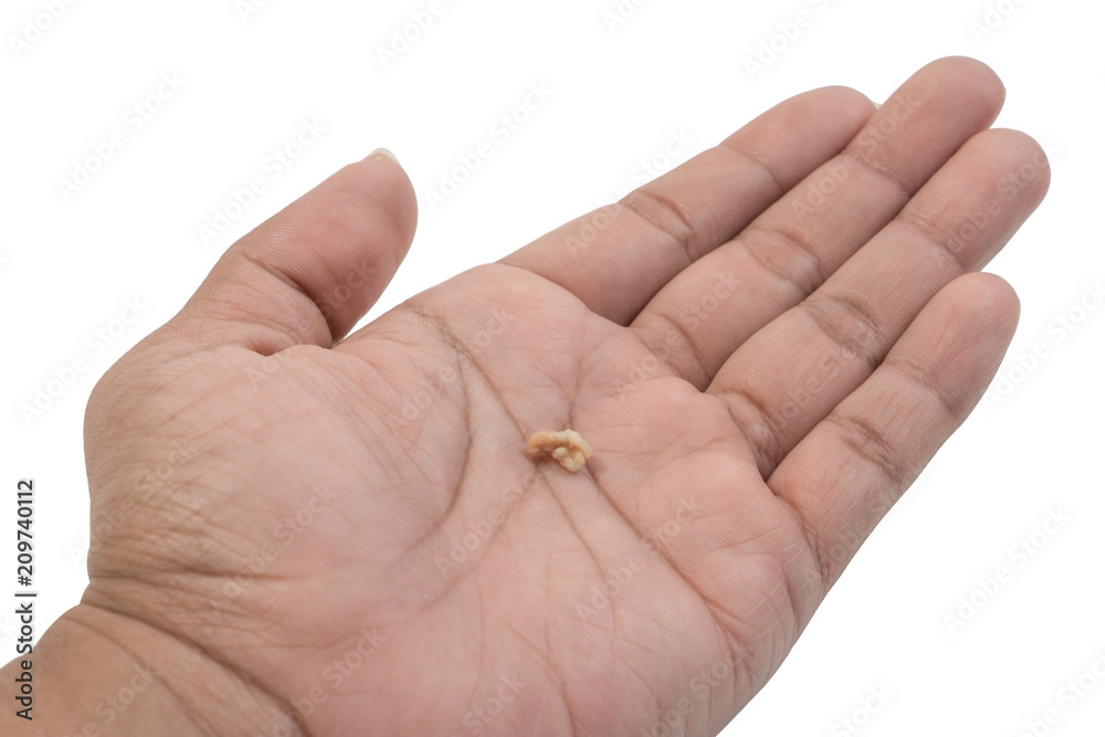 Tonsil Stone or Tonsillolith on the palm isolated on white background ...