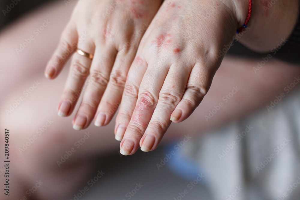 Wasp Sting On Finger