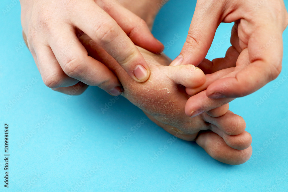 Fungus of foot close-up, isolated on blue background. The concept ...