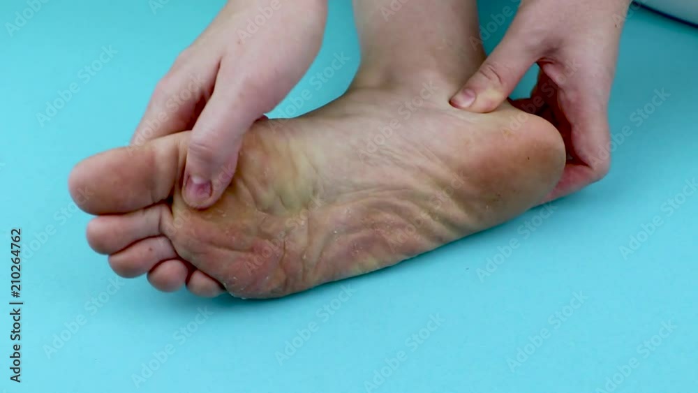 Fungus of foot close-up, isolated on blue background. The concept ...