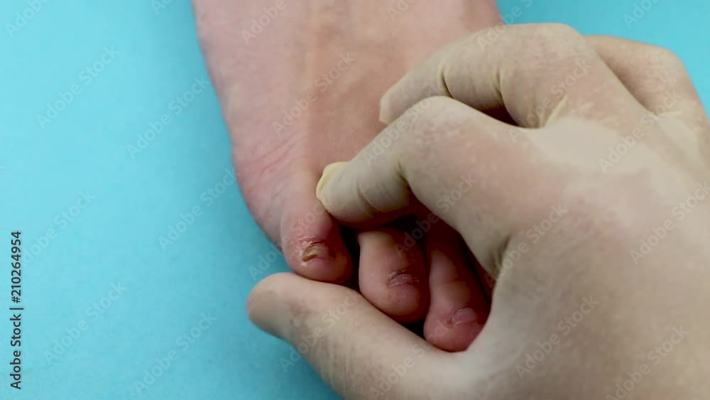 Fungus of foot close-up, isolated on blue background. The concept ...