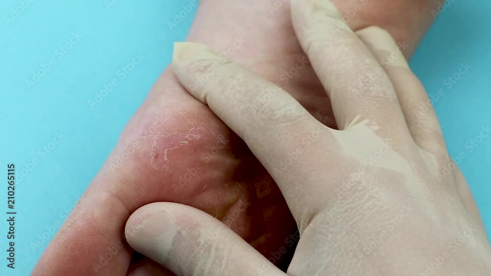 Fungus of foot close-up, isolated on blue background. The concept ...