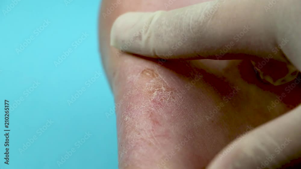 Fungus of foot close-up, isolated on blue background. The concept ...