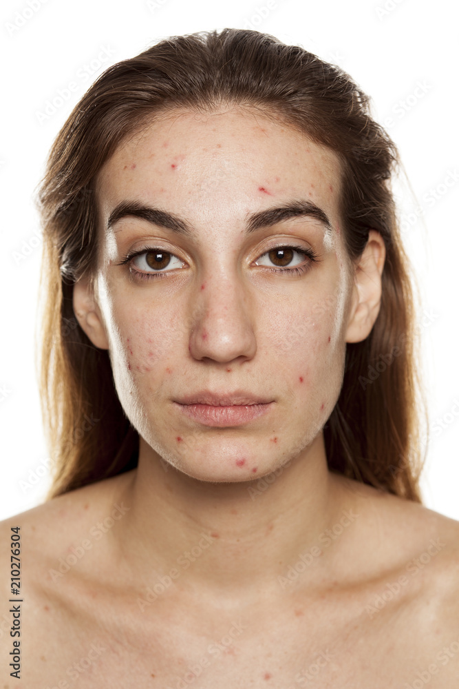 young woman with problematic skin and without makeup poses on a white ...