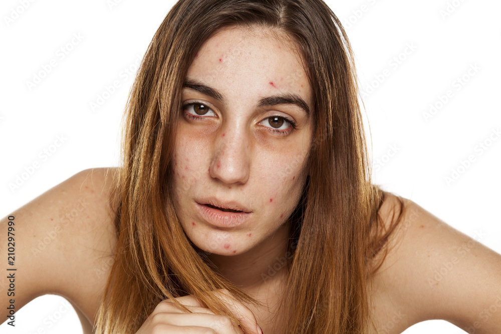 A girl with tired looks, problematic skin and dark circles around her ...