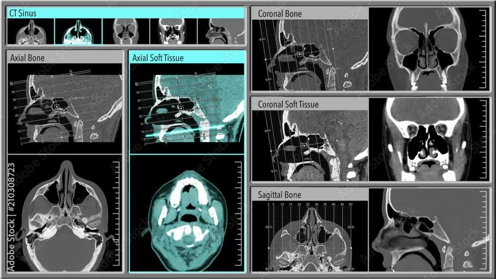 CT sinus scan (Computed tomography) (CAT scan). Healthy sinuses of adolescent female. 5 ...