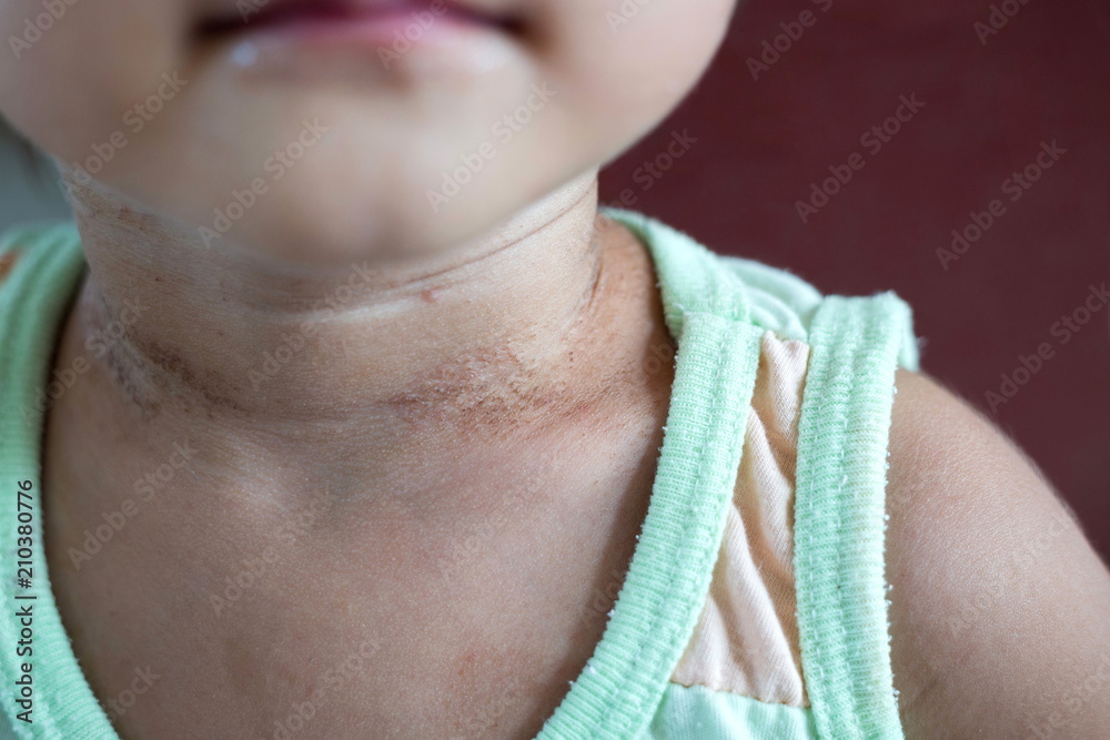 neck of children with dermatitis. Stock Photo | Adobe Stock