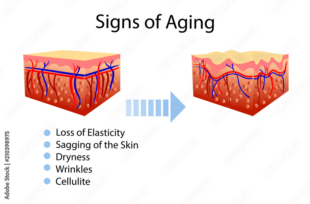 Vector diagram with signs of aging, two types of skin, for ...