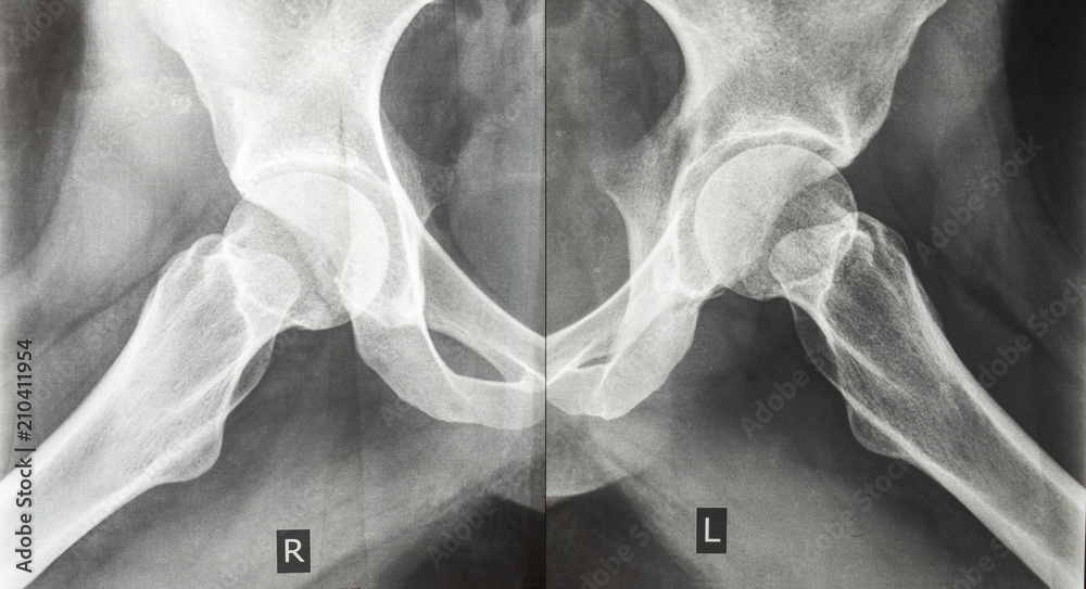 .X-ray picture of human hip joints Stock Photo | Adobe Stock