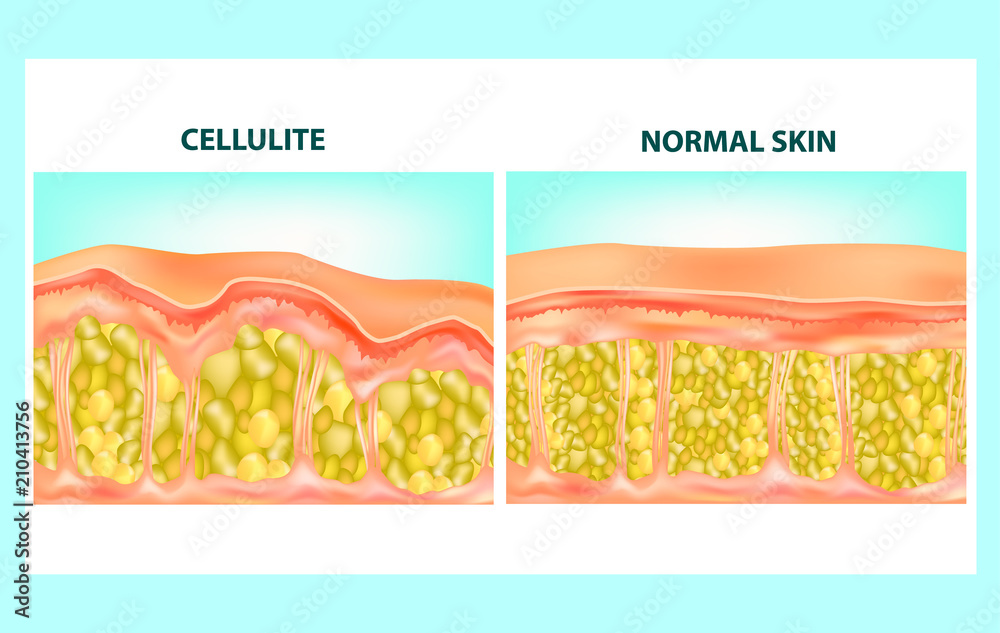 Illustration of skin cross section of Cellulite formation. Vector ...