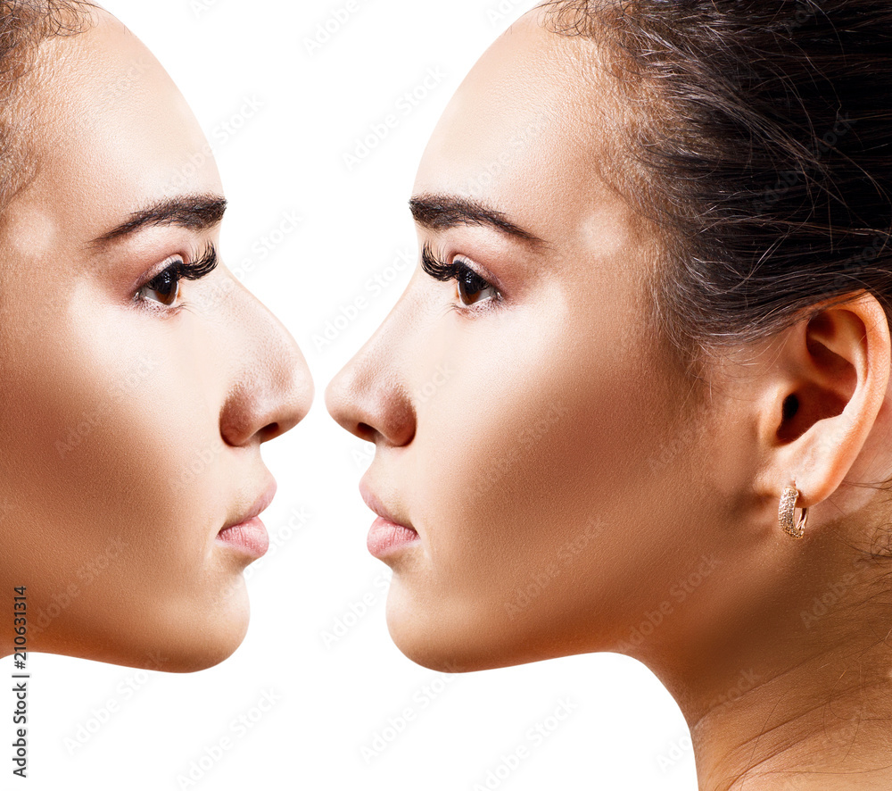 Female nose before and after cosmetic surgery. ภาพถ่ายสต็อก | Adobe Stock