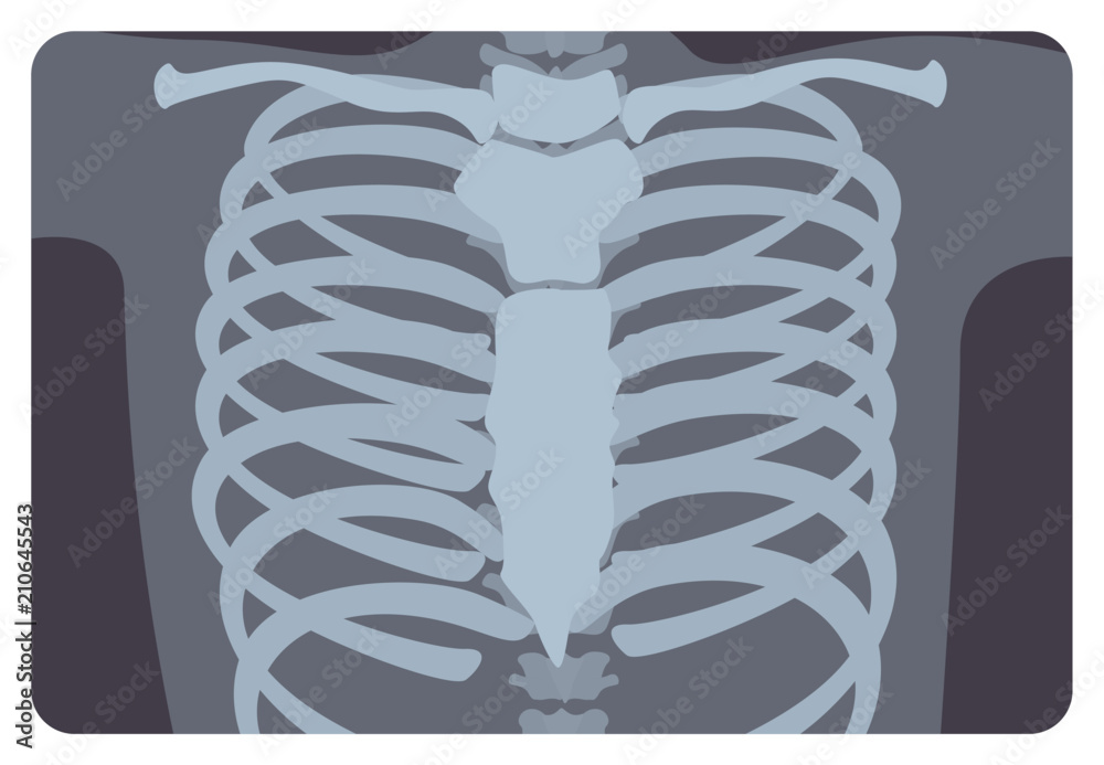 Radiograph, X-radiation picture or X-ray image of rib or thoracic cage ...