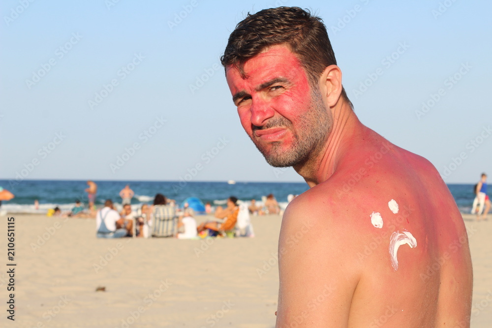 Sad man after overexposing himself to the sun Stock Photo | Adobe Stock