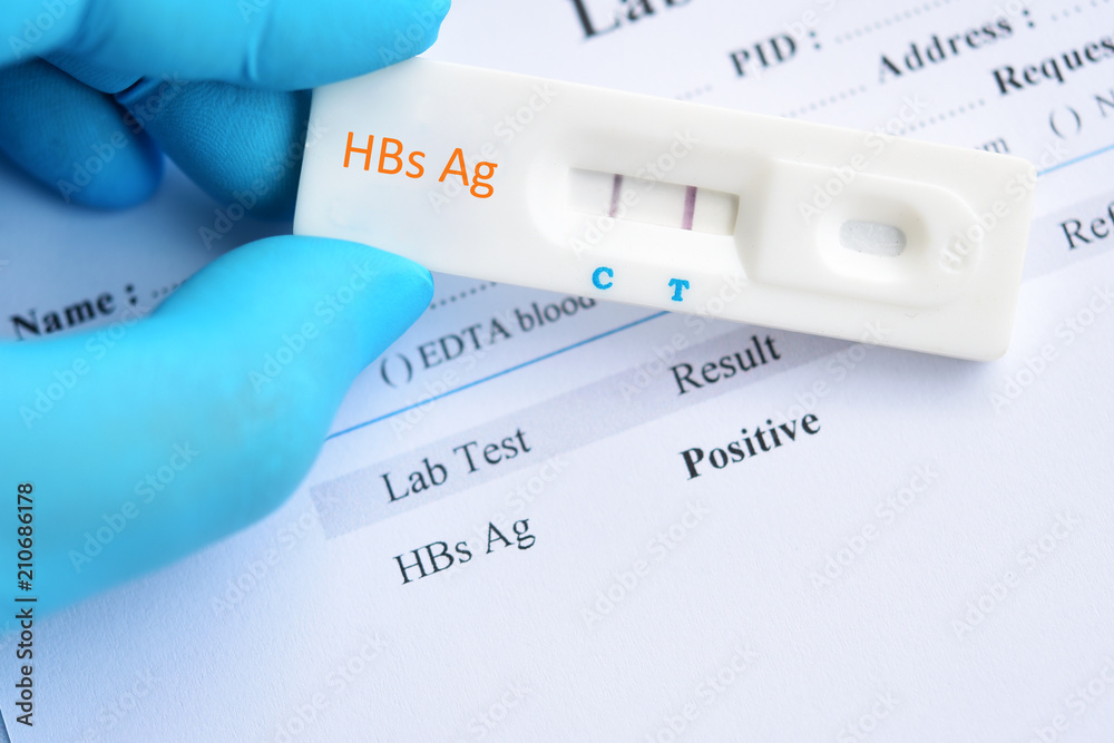 Hepatitis B virus positive test result by using rapid test cassette ...