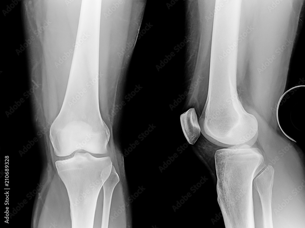 X-ray of the knee, lateral and posterior views. Stock Photo | Adobe Stock