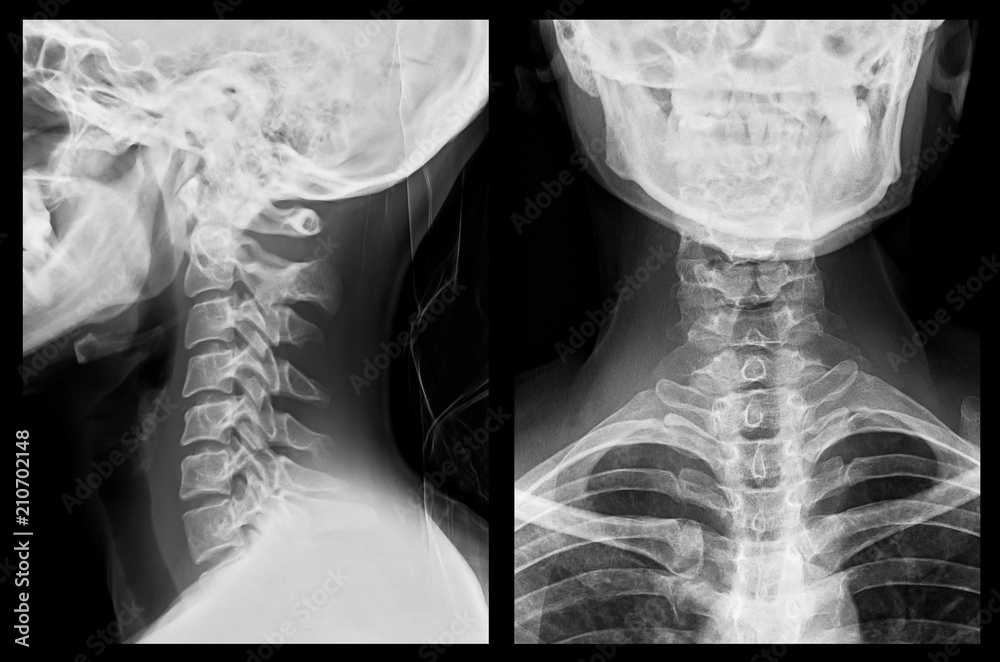 X-Ray Imaging of Spinal Column and Skull Head, lateral and posterior ...