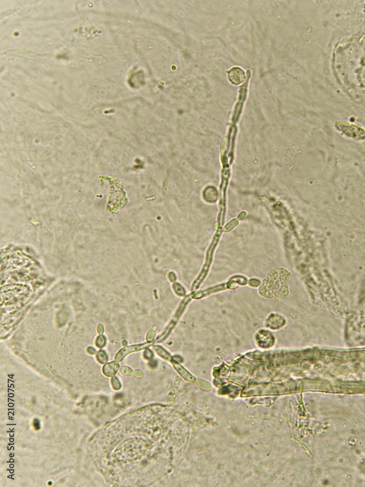 Hyphae Yeast In Urine