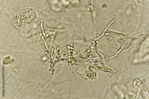 Candida Pseudohyphae