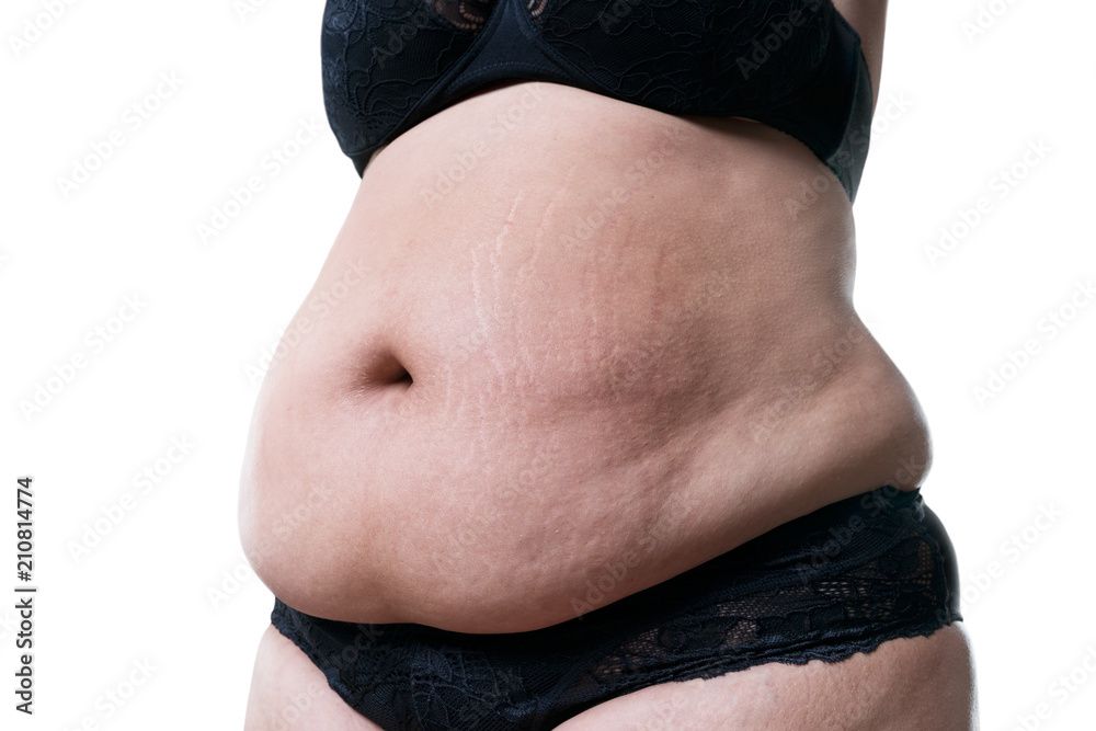Obese Belly Women