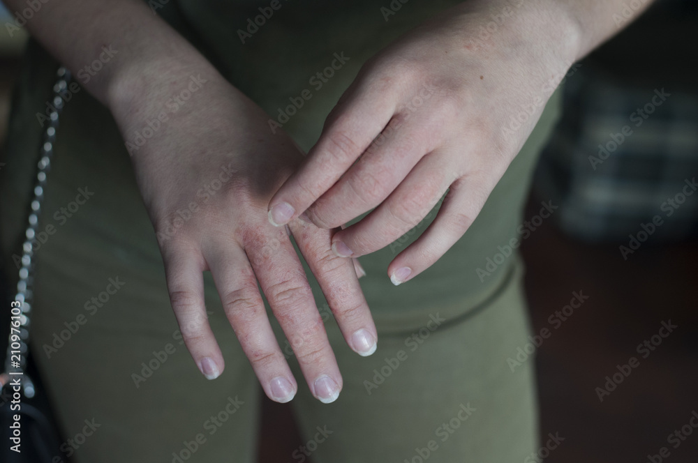 Scabies in hands. Dermatology problem. Infection Stock Photo | Adobe Stock