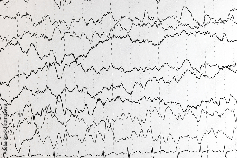 EEG of the pediatric patients, problems in the electrical activity of ...
