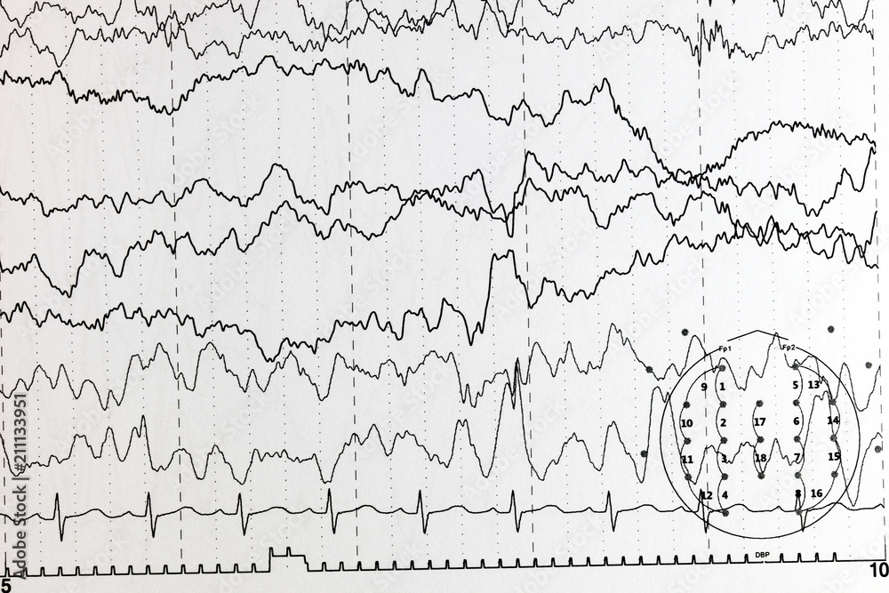 Abnormal Eeg