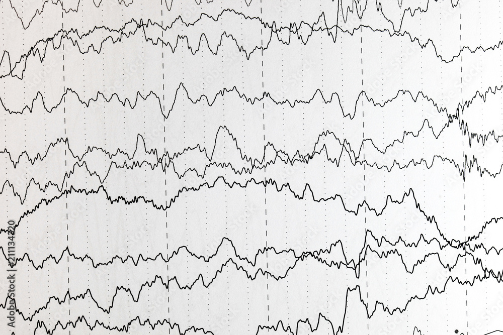 Abnormal Eeg
