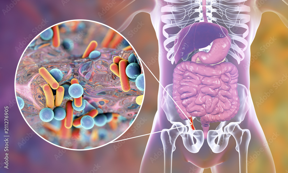 Acute appendicitis and close-up view of bacteria in appendix, the ...