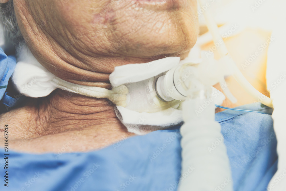 Patient do tracheostomy and ventilator in hospital Stock Photo | Adobe ...