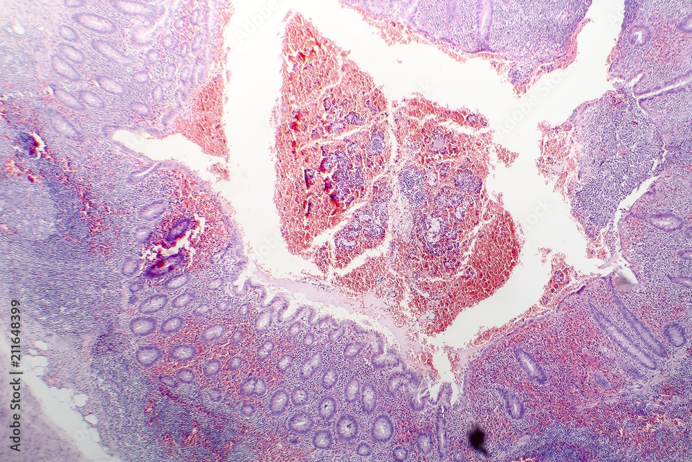 Histopathology of chronic appendicitis, light micrograph, photo under ...