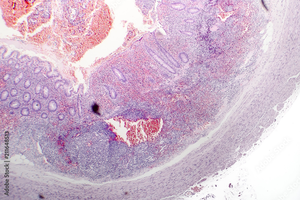 Histopathology of chronic appendicitis, light micrograph, photo under ...