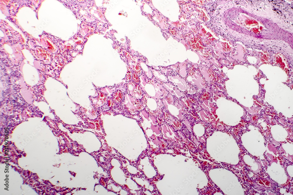 Photo & Art Print Chronic pulmonary congestion and edema, light ...