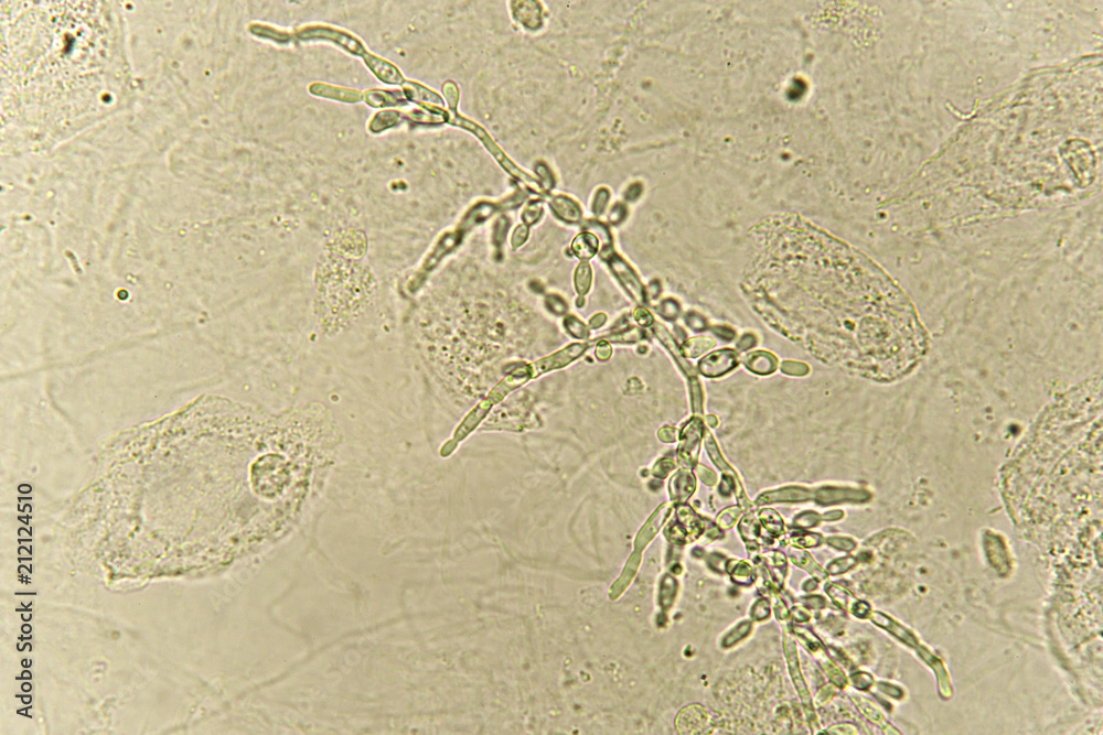Pseudohyphae and budding yeast cells in patient urine Stock Photo ...